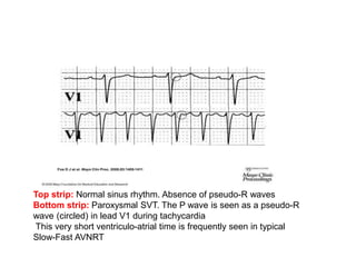 AVNRT,TYPES AND HOW TO INTERPRET IN ECG? | PPTX