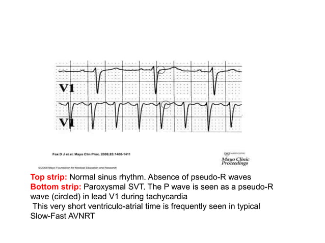 AVNRT,TYPES AND HOW TO INTERPRET IN ECG? | PPT