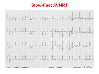 AVNRT,TYPES AND HOW TO INTERPRET IN ECG? | PPTX