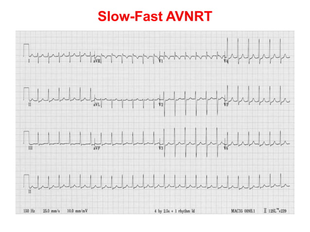 AVNRT,TYPES AND HOW TO INTERPRET IN ECG? | PPT