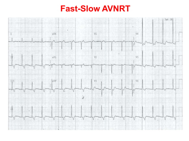 AVNRT,TYPES AND HOW TO INTERPRET IN ECG? | PPT