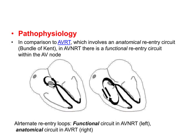 AVNRT,TYPES AND HOW TO INTERPRET IN ECG? | PPT