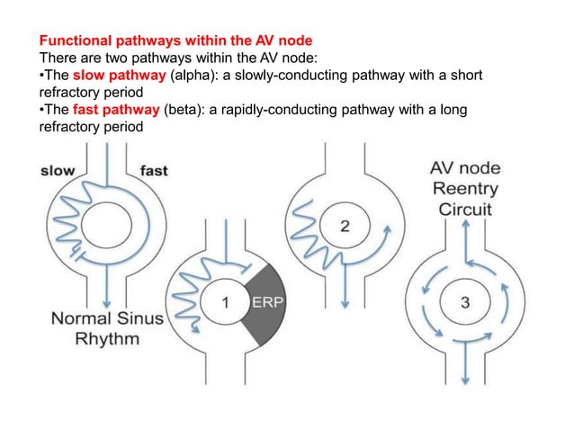 AVNRT,TYPES AND HOW TO INTERPRET IN ECG? | PPT