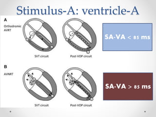 narrow QRS tachycardia diagnostic pacing maneuvers | PPTX