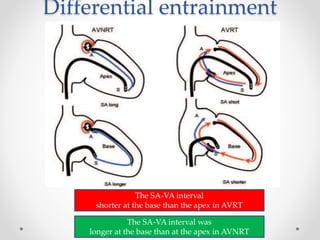 narrow QRS tachycardia diagnostic pacing maneuvers | PPTX