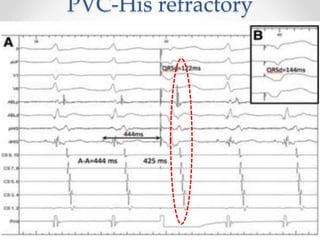 narrow QRS tachycardia diagnostic pacing maneuvers | PPTX