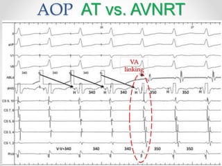 narrow QRS tachycardia diagnostic pacing maneuvers | PPT