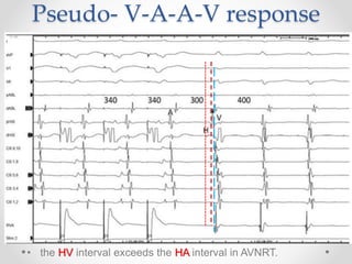 narrow QRS tachycardia diagnostic pacing maneuvers | PPTX
