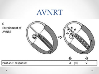 narrow QRS tachycardia diagnostic pacing maneuvers | PPTX