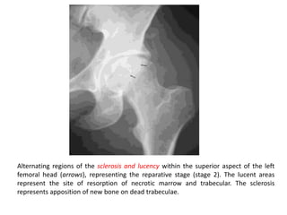 Avascular necrosis of Hip Xray | PPTX