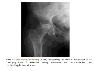 Avascular necrosis of Hip Xray | PPTX