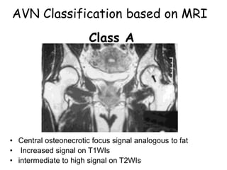 Avascular necrosis of Hip Xray | PPTX