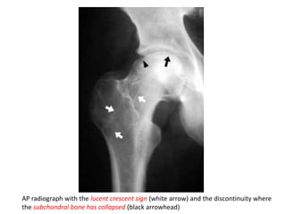 Avascular necrosis of Hip Xray | PPTX