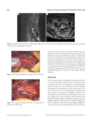 SURGICAL MANAGEMENT OF SYMPTOMATIC TARLOV CYSTS | PDF