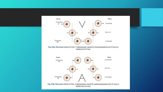 A – V PATTERNS : Introduction , Types & Management | PPT