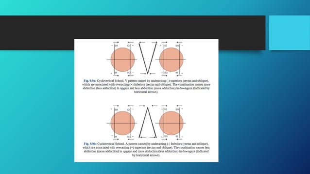 A – V PATTERNS : Introduction , Types & Management | PPT