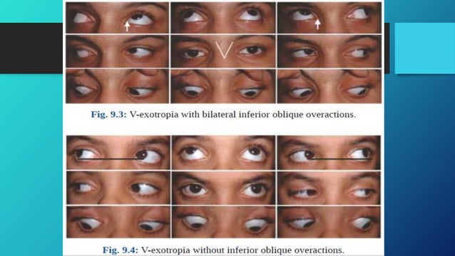 A – V PATTERNS : Introduction , Types & Management | PPT
