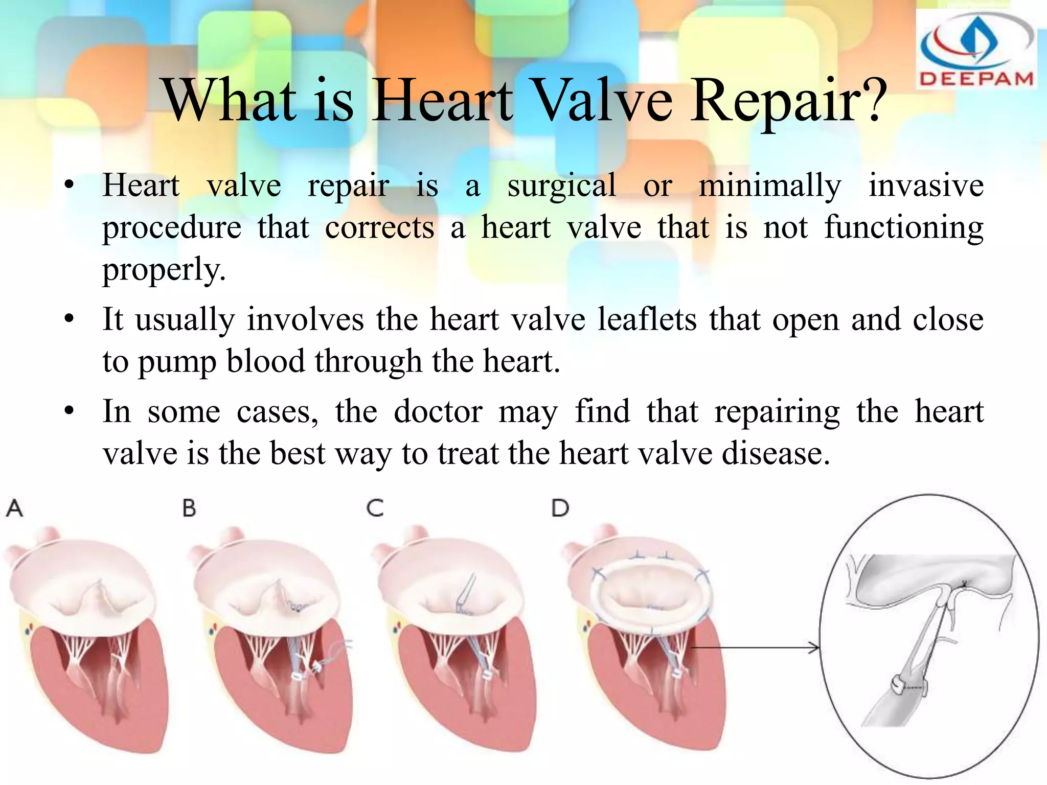 AVR - MVR all you need to know about Valve Repair & Replacement | PPTX