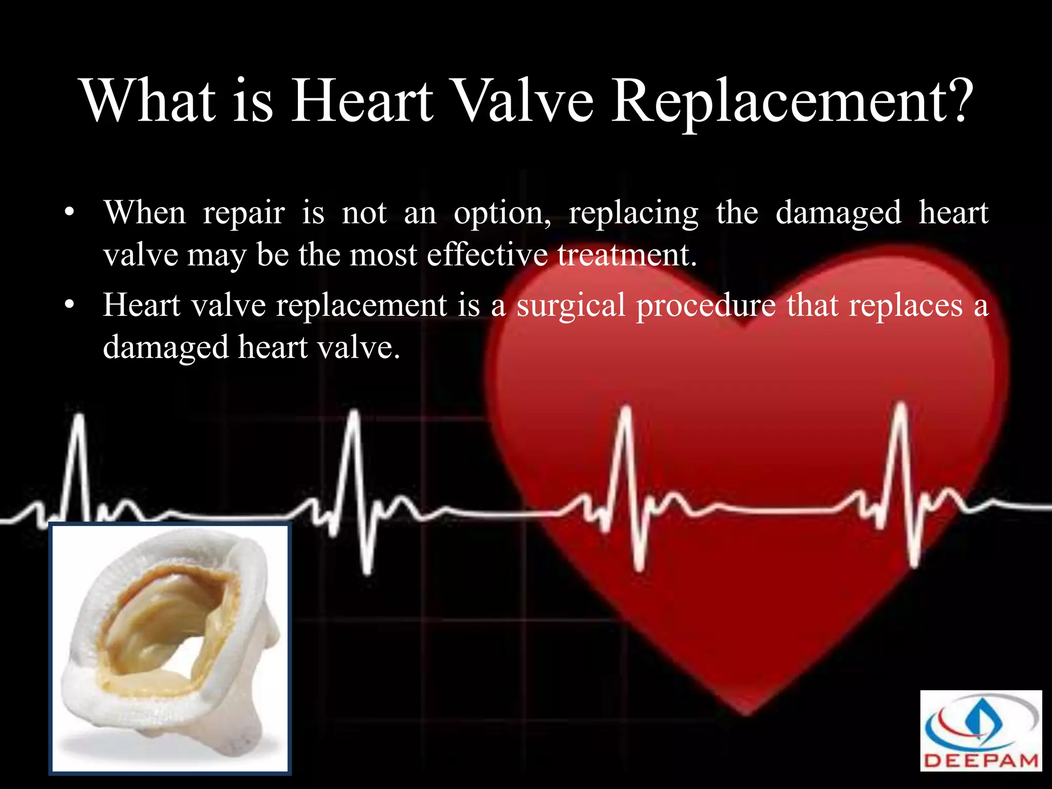 AVR - MVR all you need to know about Valve Repair & Replacement | PPTX