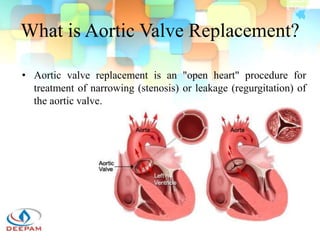AVR - MVR all you need to know about Valve Repair & Replacement | PPTX