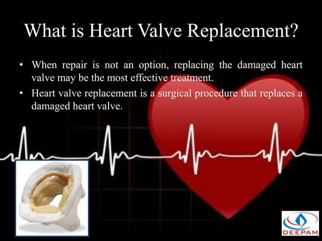 AVR - MVR all you need to know about Valve Repair & Replacement | PPTX