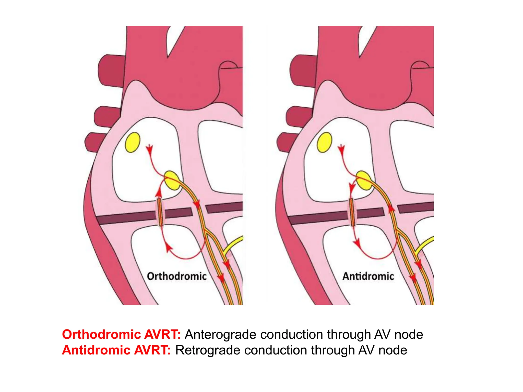 AVRT,TYPES AND HOW TO INTERPRET IN ECG?? | PPTX
