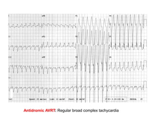 AVRT,TYPES AND HOW TO INTERPRET IN ECG?? | PPTX