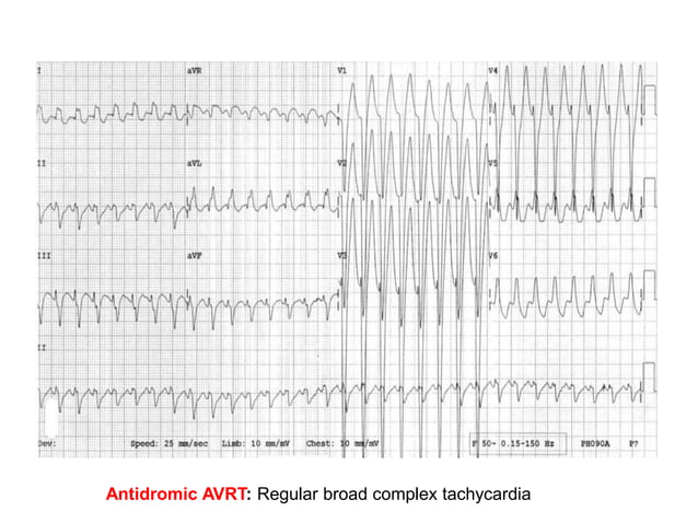 AVRT,TYPES AND HOW TO INTERPRET IN ECG?? | PPTX | Heart and ...