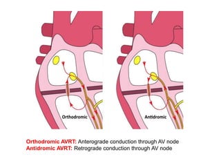 AVRT,TYPES AND HOW TO INTERPRET IN ECG?? | PPTX