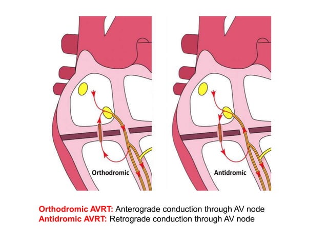 AVRT,TYPES AND HOW TO INTERPRET IN ECG?? | PPTX | Heart and ...