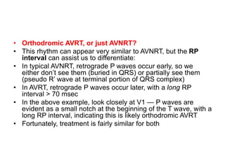 AVRT,TYPES AND HOW TO INTERPRET IN ECG?? | PPTX