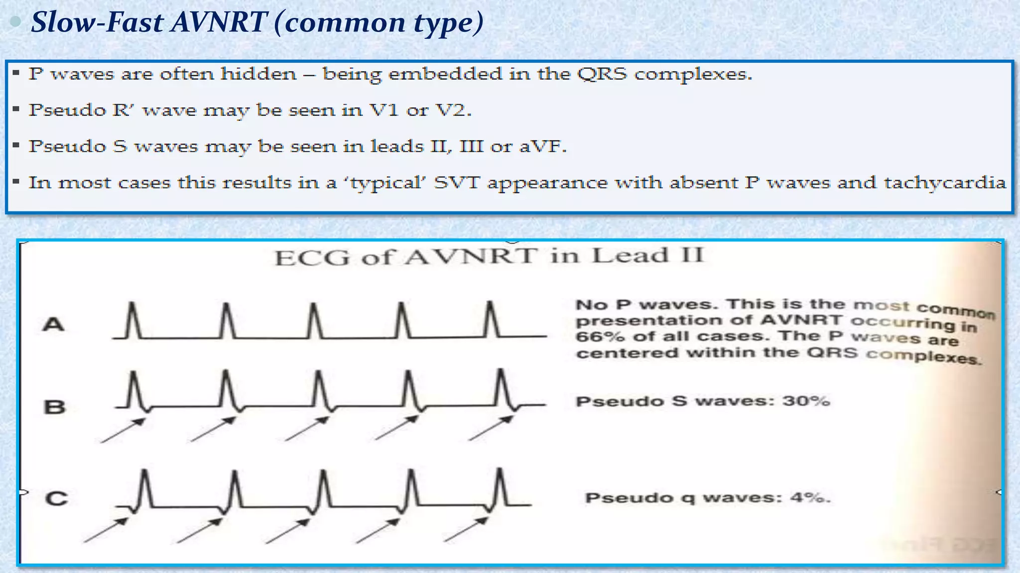 Avrt and avnrt | PPTX