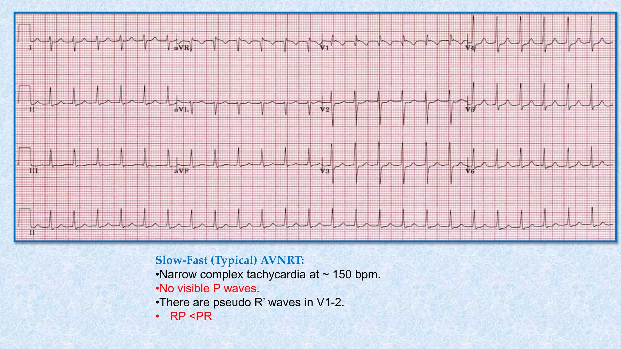 Avrt and avnrt | PPTX