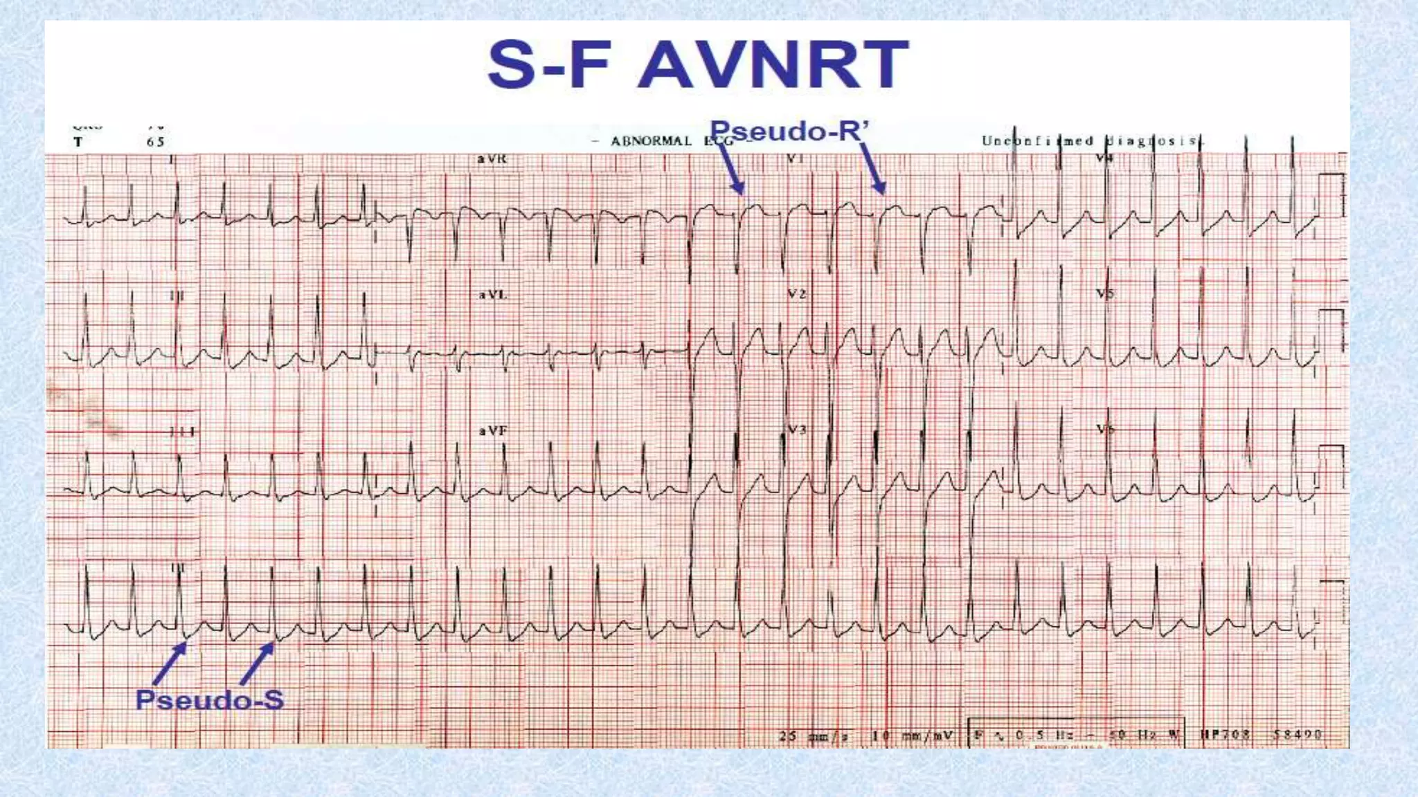 Avrt and avnrt | PPTX
