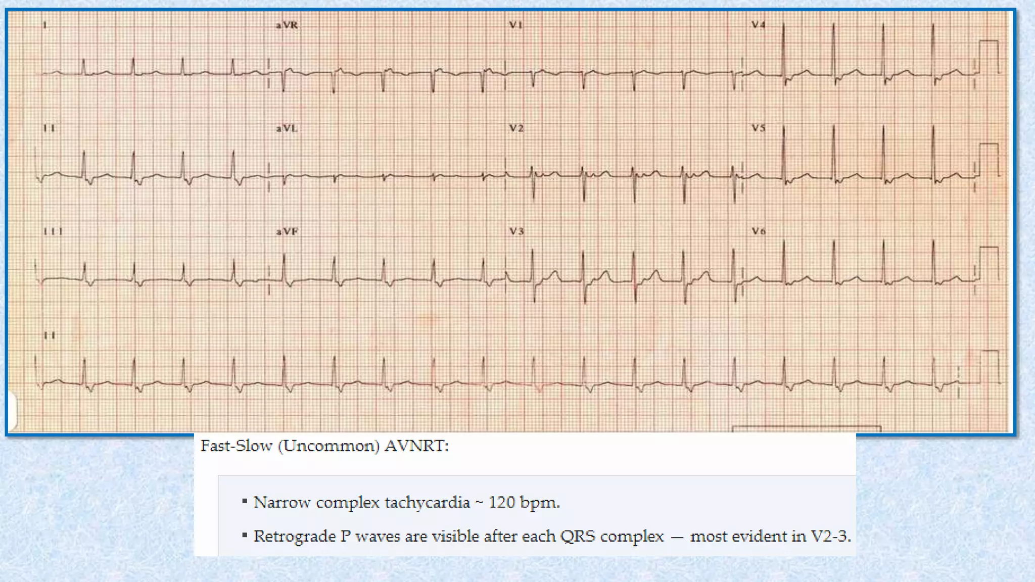 Avrt and avnrt | PPTX