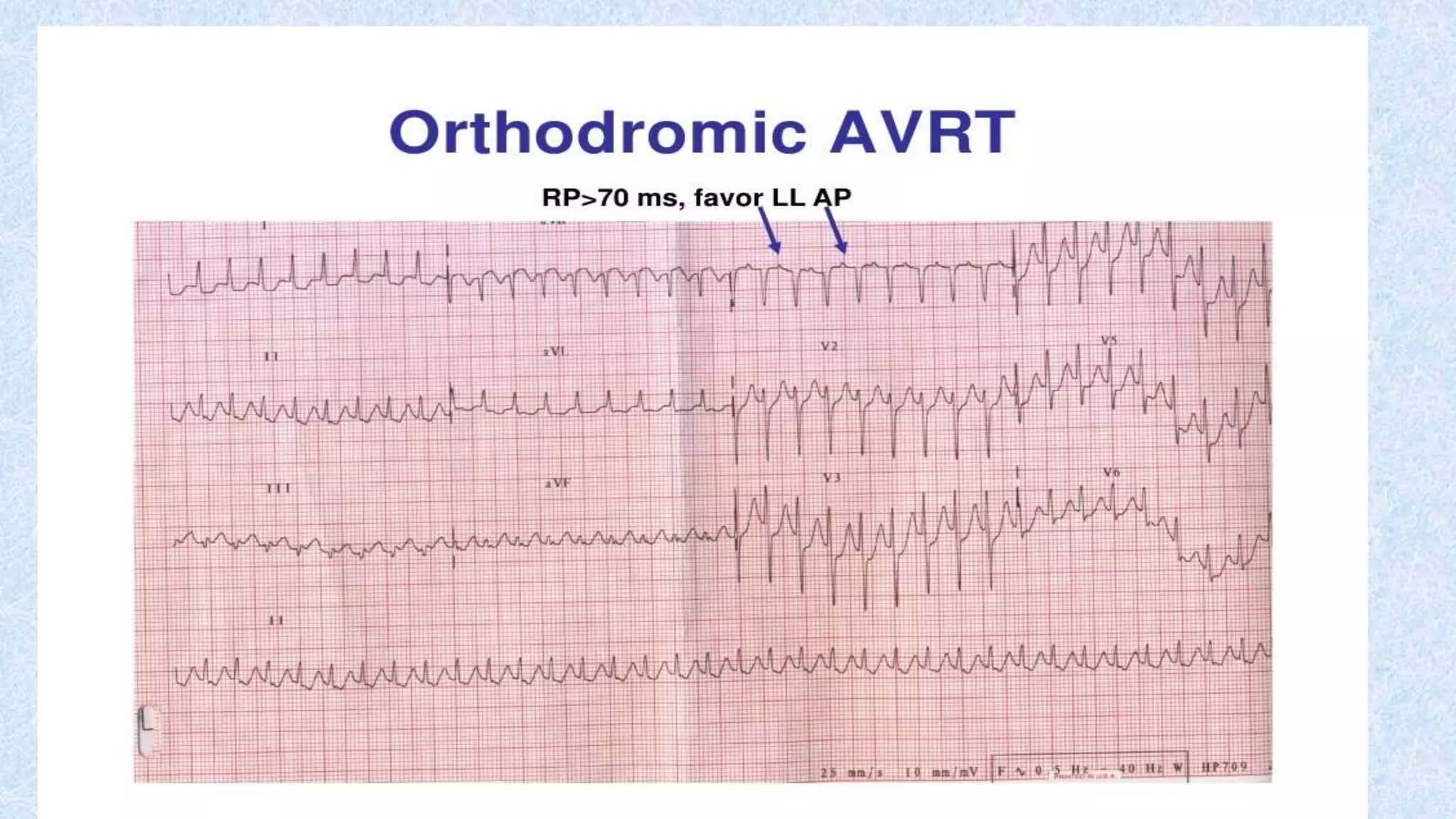 Avrt and avnrt | PPTX