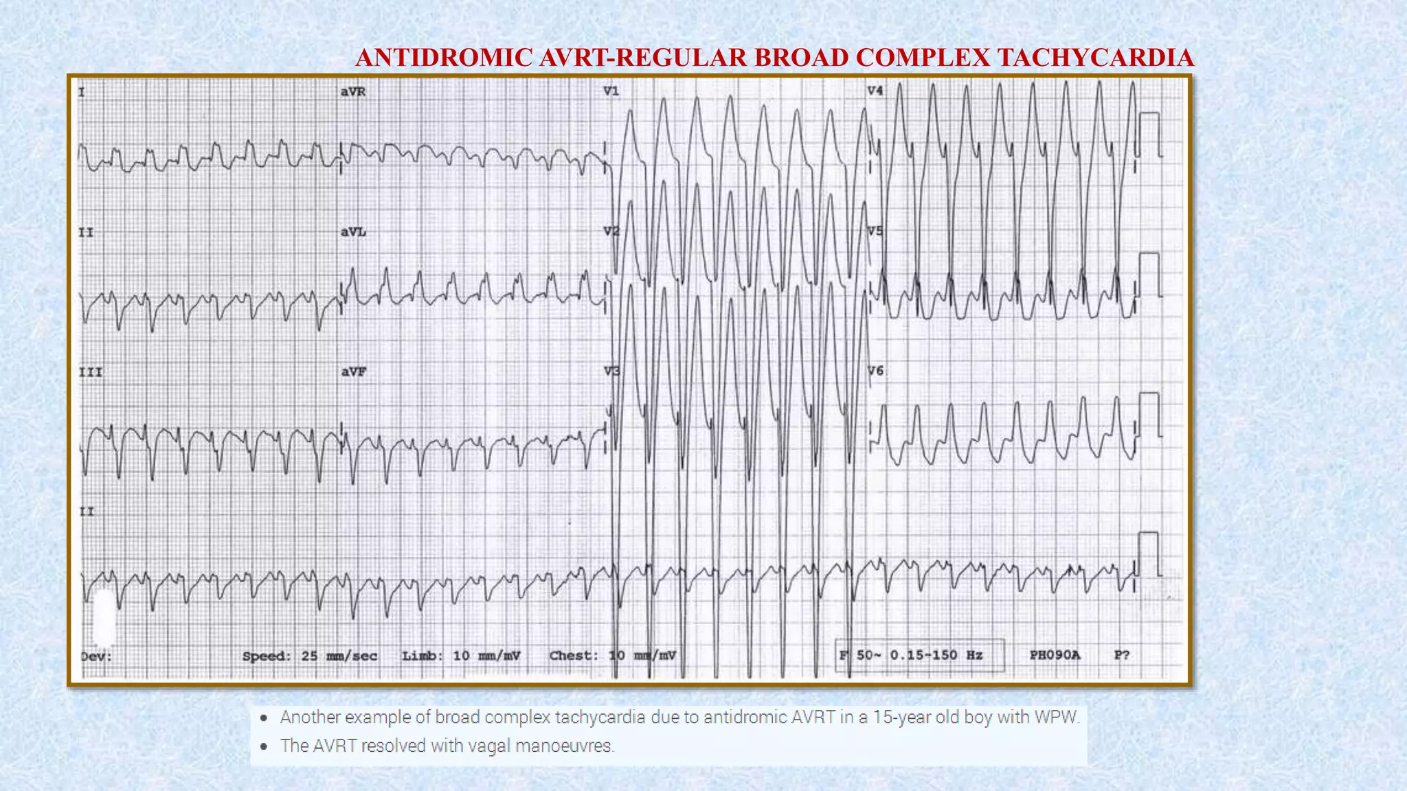Avrt and avnrt | PPTX