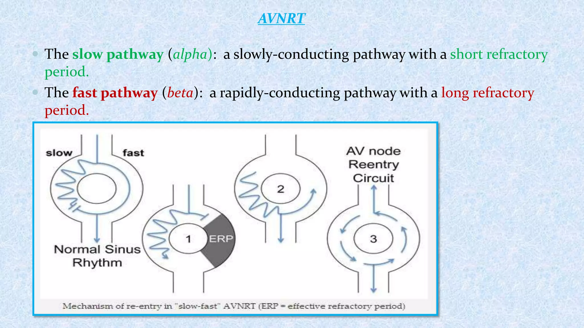 Avrt and avnrt | PPTX