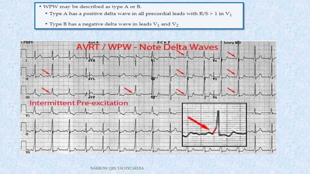 Avrt and avnrt | PPTX | Heart and Cardiovascular Diseases | Diseases ...