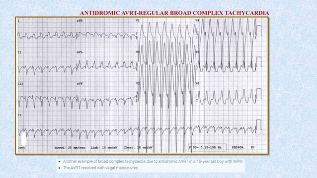 Avrt and avnrt | PPTX | Heart and Cardiovascular Diseases | Diseases ...