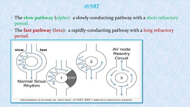 Avrt and avnrt | PPTX | Heart and Cardiovascular Diseases | Diseases ...