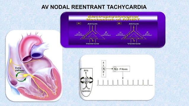Avrt and avnrt | PPTX | Heart and Cardiovascular Diseases | Diseases ...