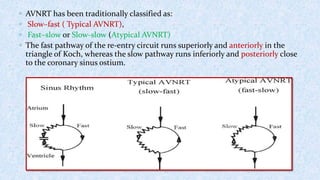 Avrt and avnrt | PPTX
