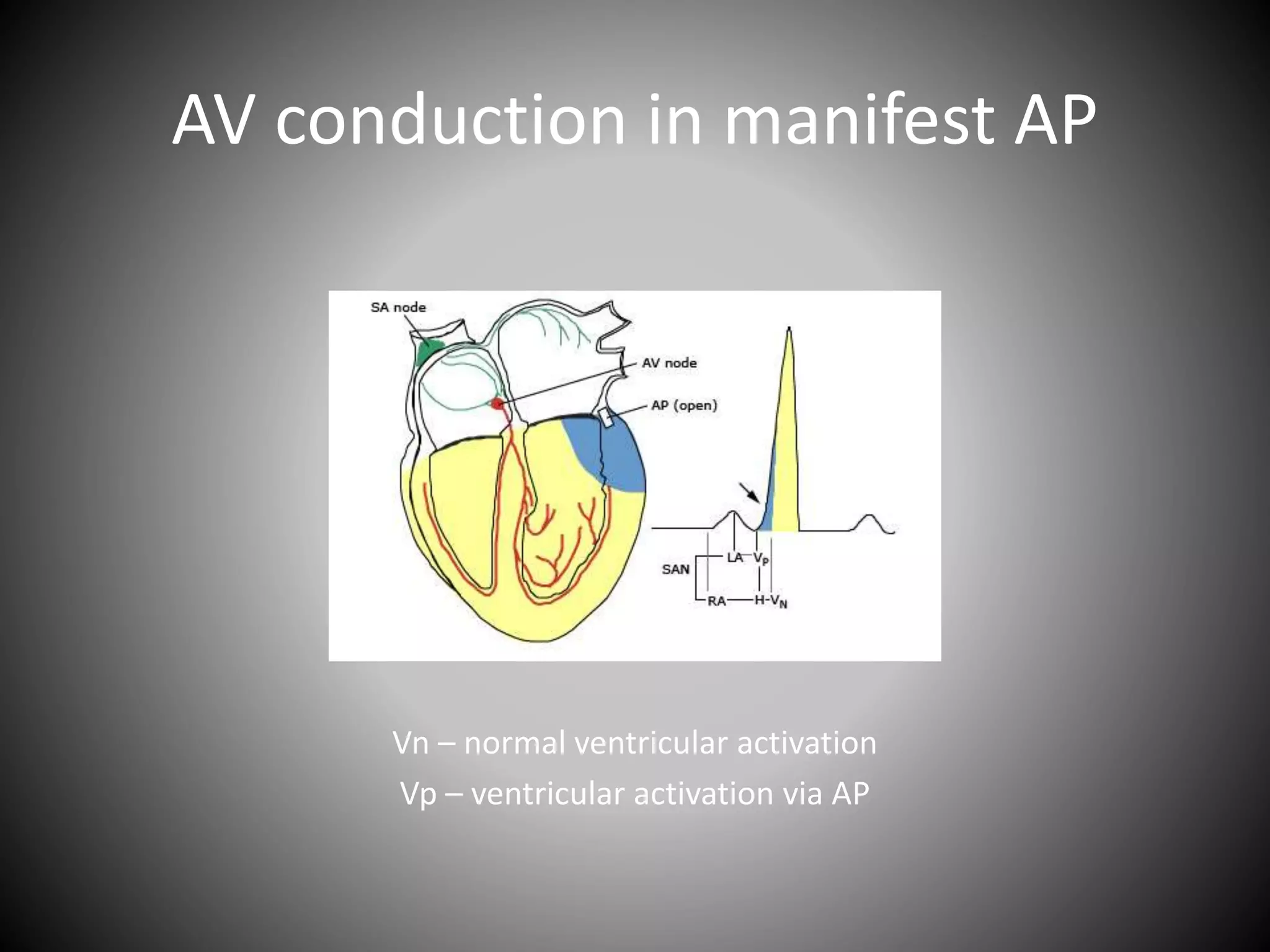 Electrophysiology AVRT | PPTX