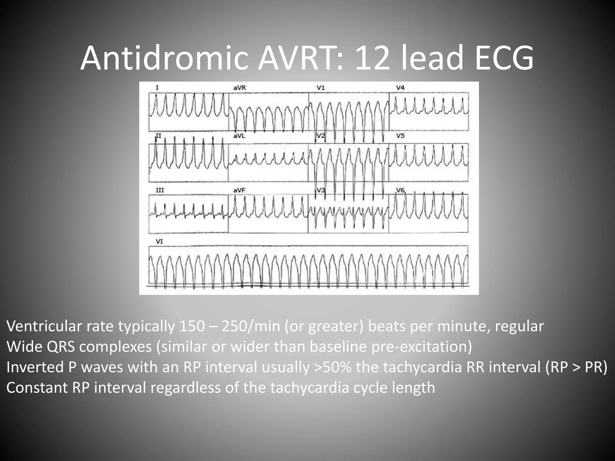Electrophysiology AVRT | PPTX