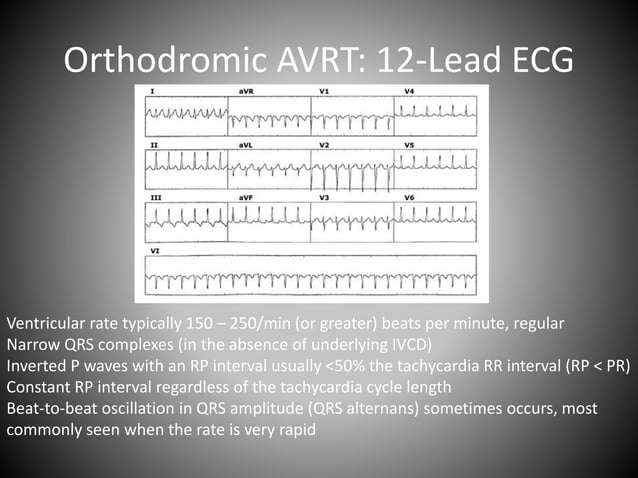 Electrophysiology AVRT | PPTX | Heart and Cardiovascular Diseases ...