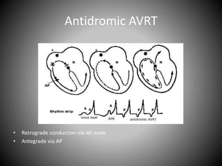 Avrt Antidromico