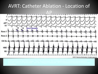 Electrophysiology AVRT | PPT