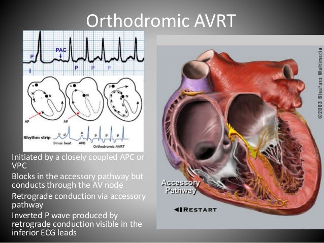 Electrophysiology AVRT