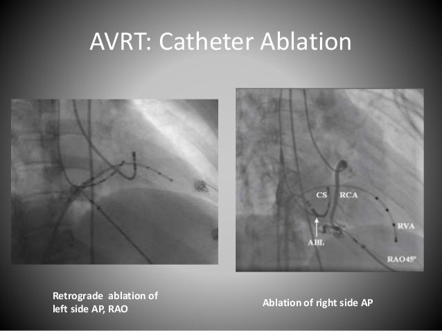 Electrophysiology AVRT